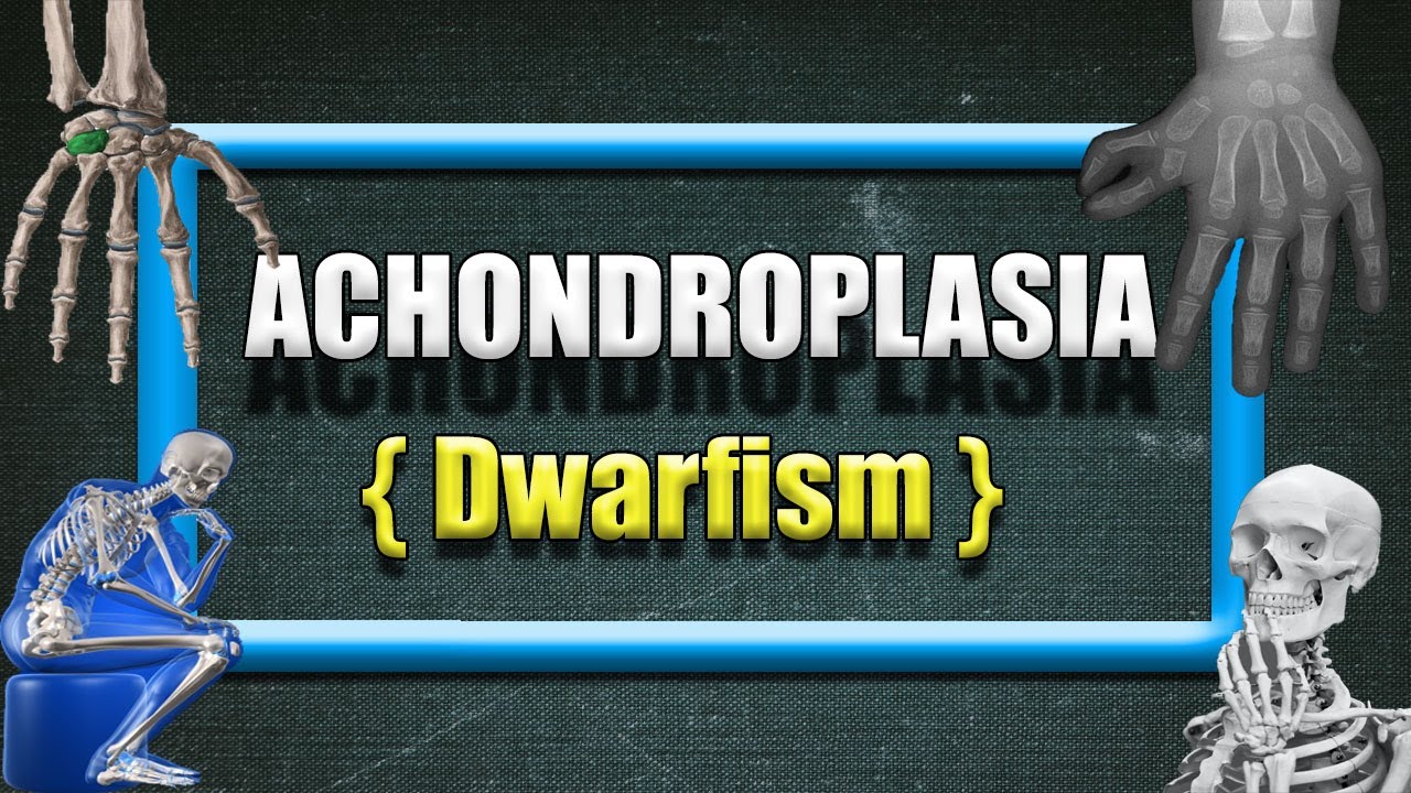 Achondroplasia | Dwarfism | बौनापन | Autosomal Genetic Disorders ...