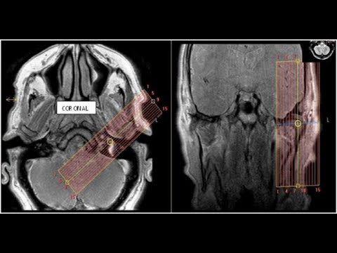 TMJ MRI & CBCT 3D Imaging - YouTube