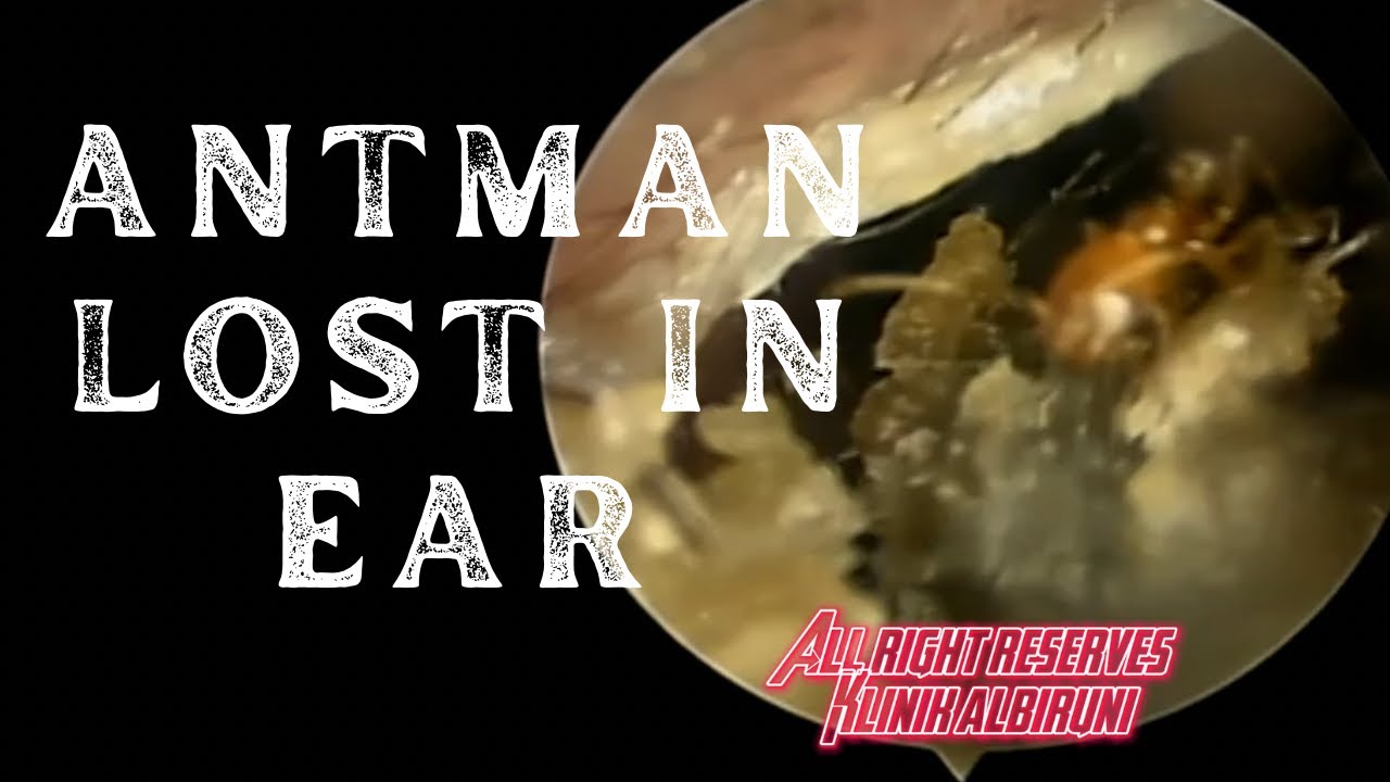 Ant inside Ear! - YouTube