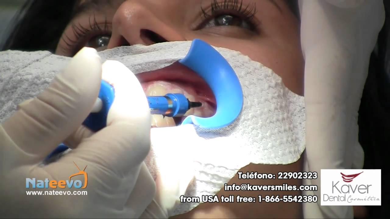 Procedimiento de Blanqueo Dental - YouTube