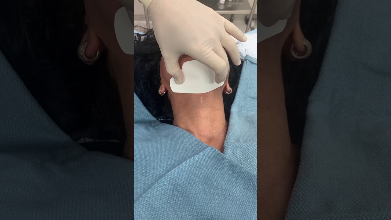 How To Apply The Kybella Skin Marking Grid YouTube How To Apply The Kybella Skin Marking Grid YouTube
