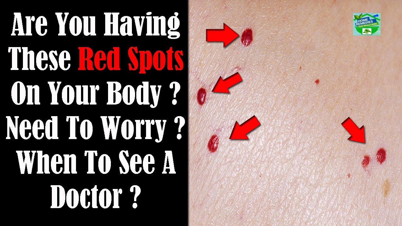 Are You Having These Red Spots On Your Body Need To Worry When To are-you-having-these-red-spots-on-your-body-need-to-worry-when-to