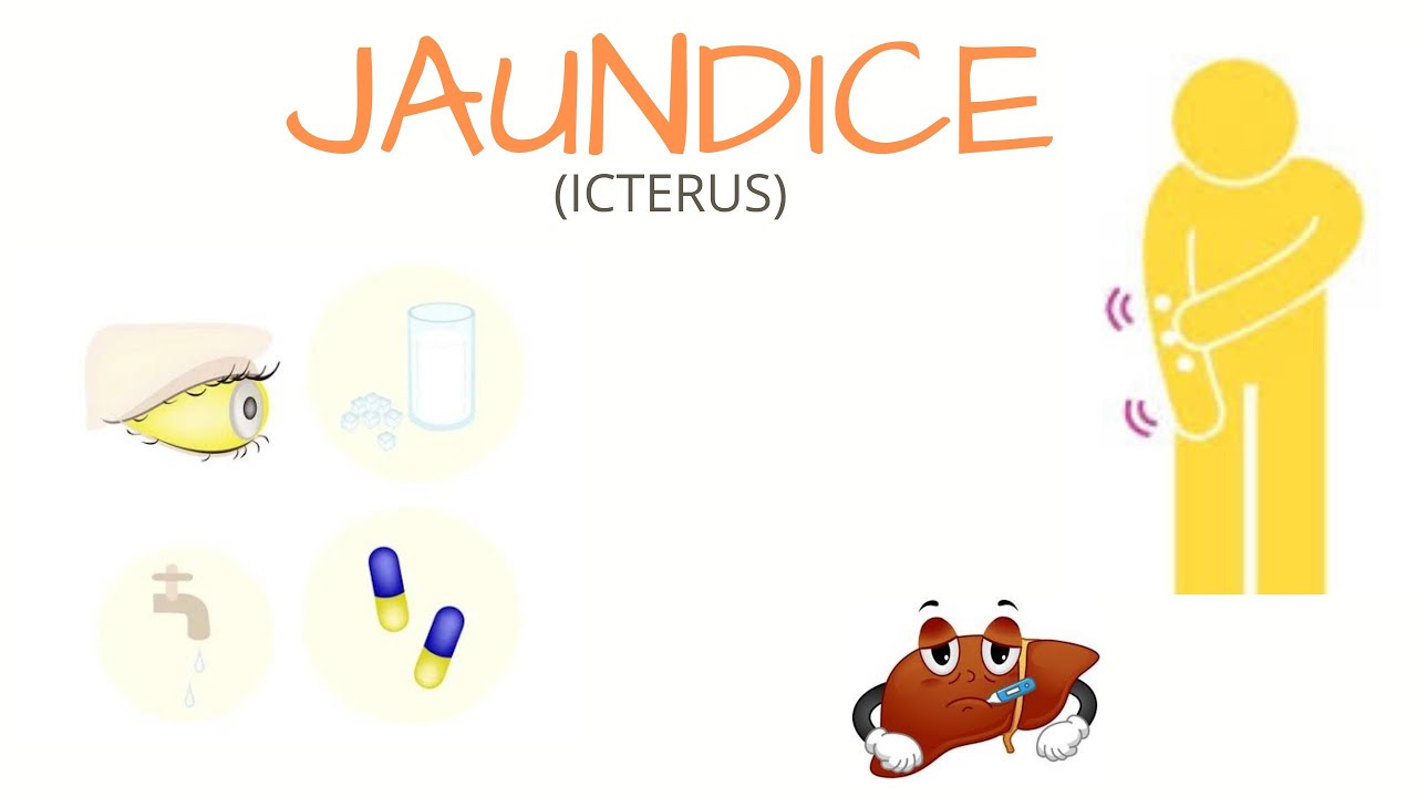 JAUNDICE (ICTERUS): Causes, pathophysiology, types, diagnosis ...