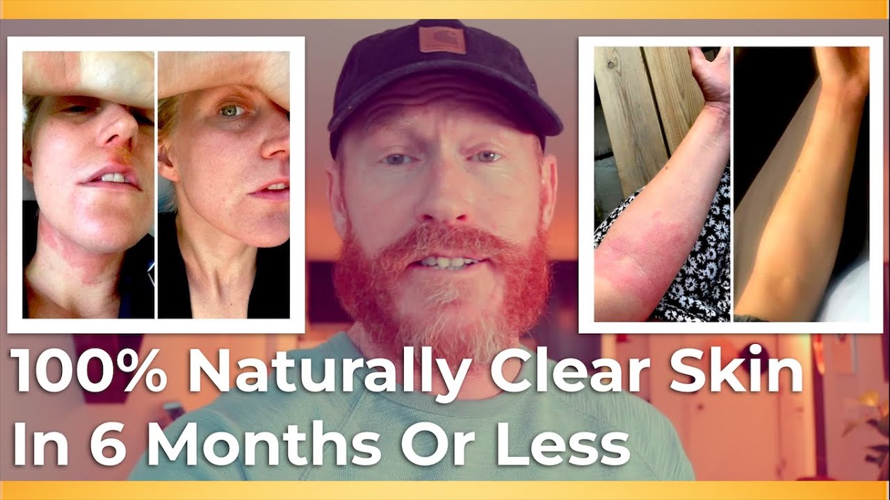 100% Naturally Clear Skin In 6 Months Or Less (Eczema, Psoriasis ...
