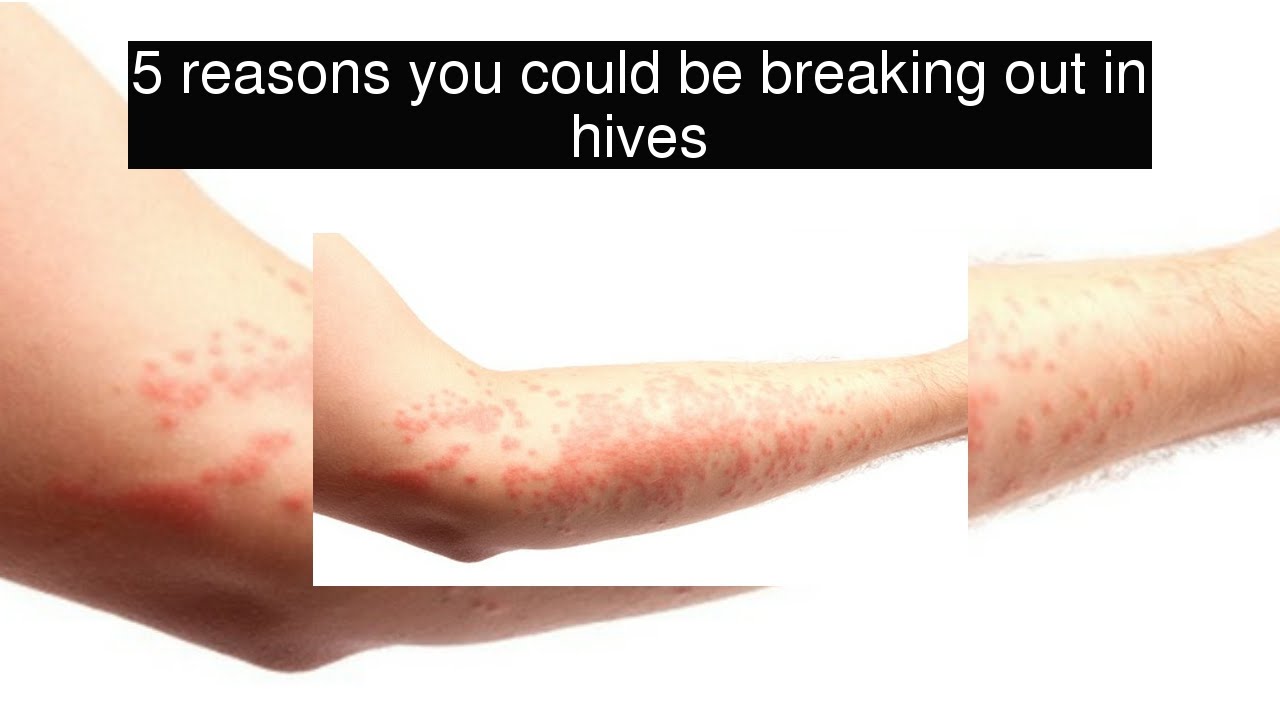 5 reasons you could be breaking out in hives - YouTube