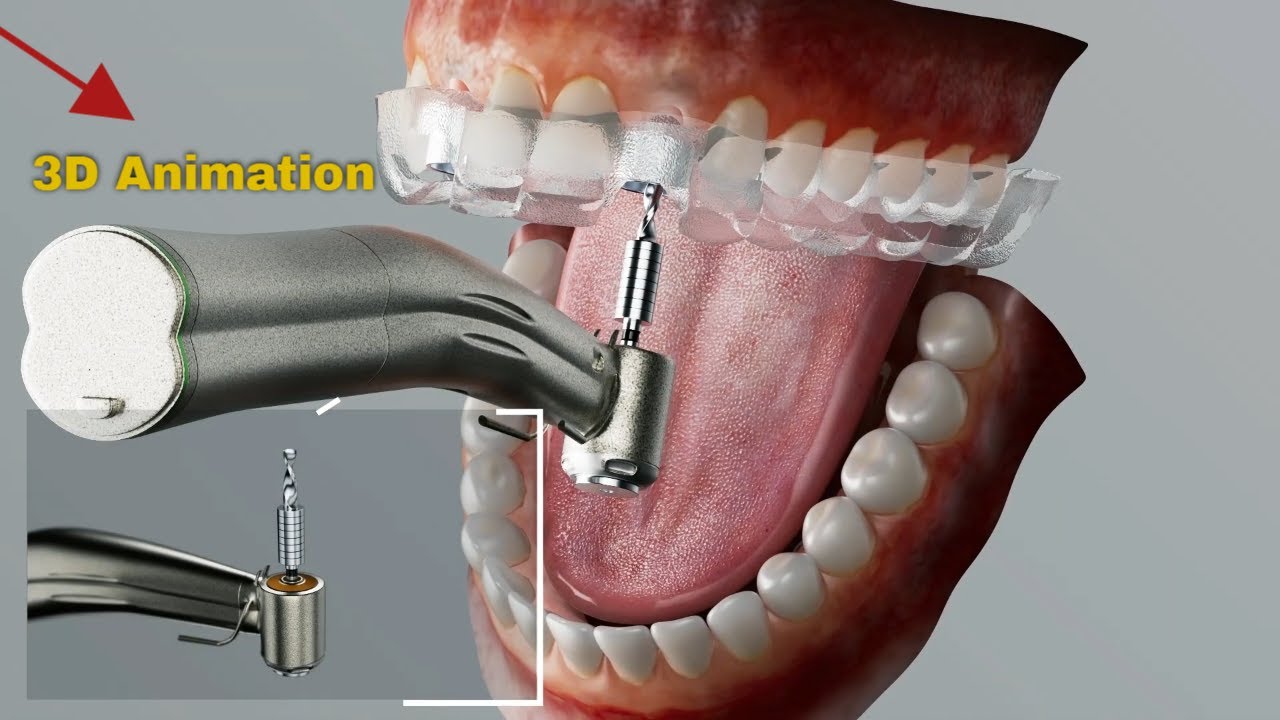 Realistic 3D Dental Implant Animation | Blender & Cinema 4D Product ...