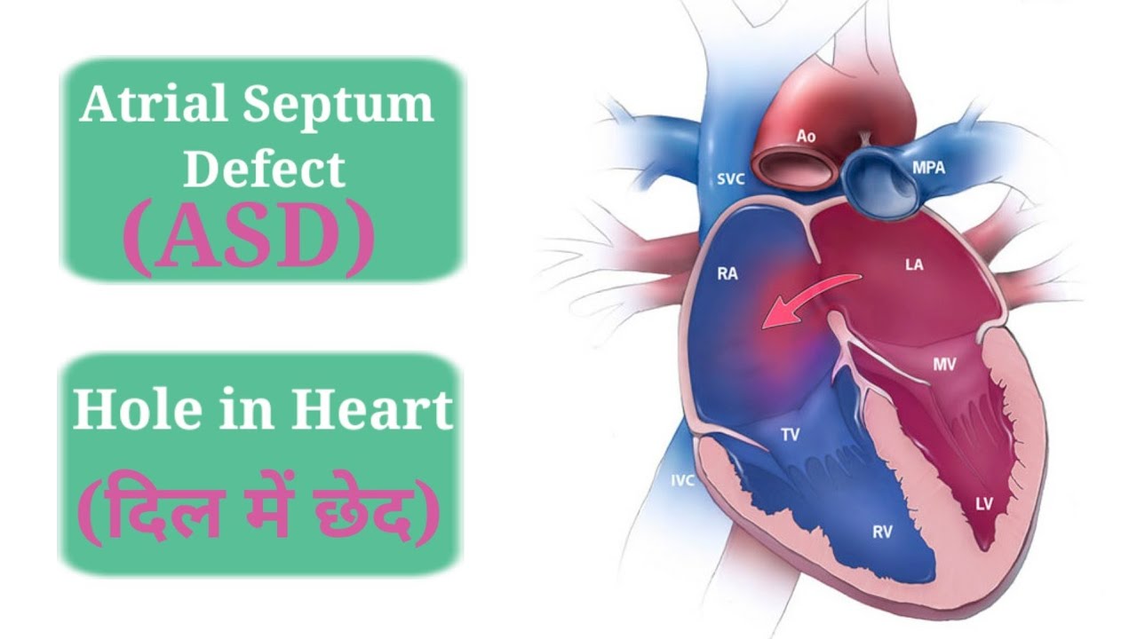 Atrial septal defect/ASD/Hole in heart / ASD की पूरी जानकारी - YouTube