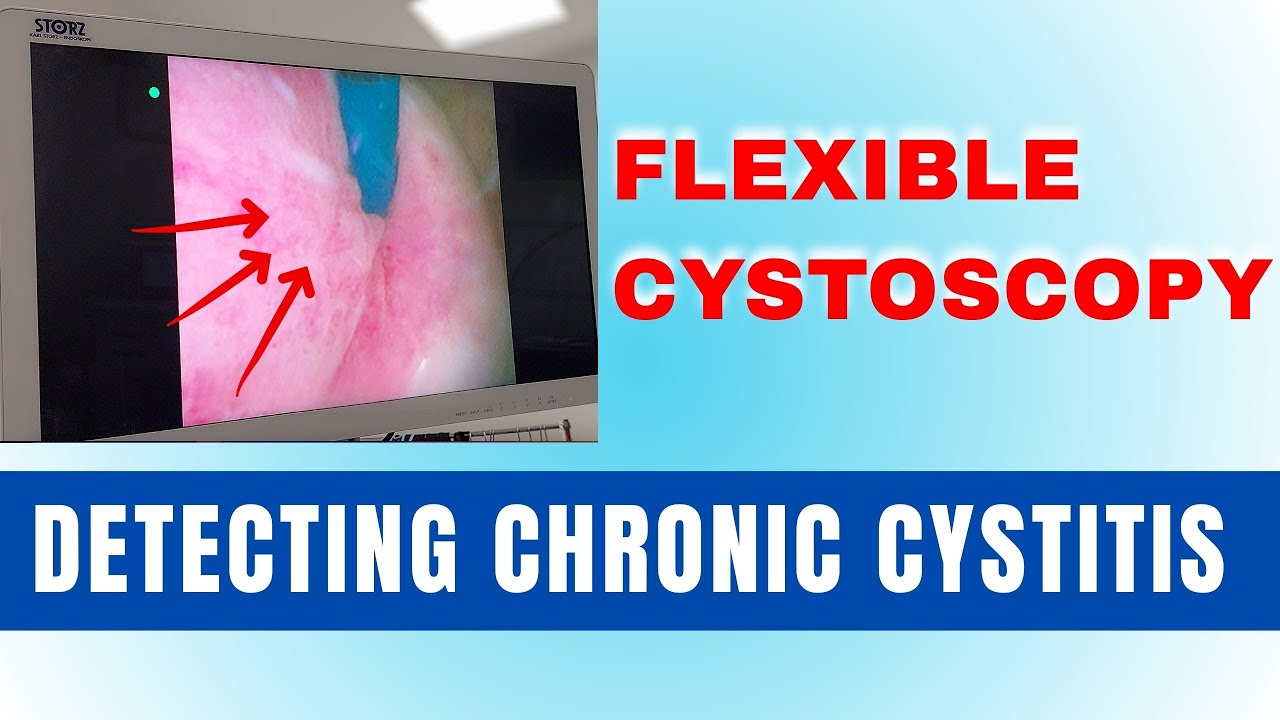 See How We Diagnose Chronic Cystitis Using Flexible Cystoscopy - YouTube