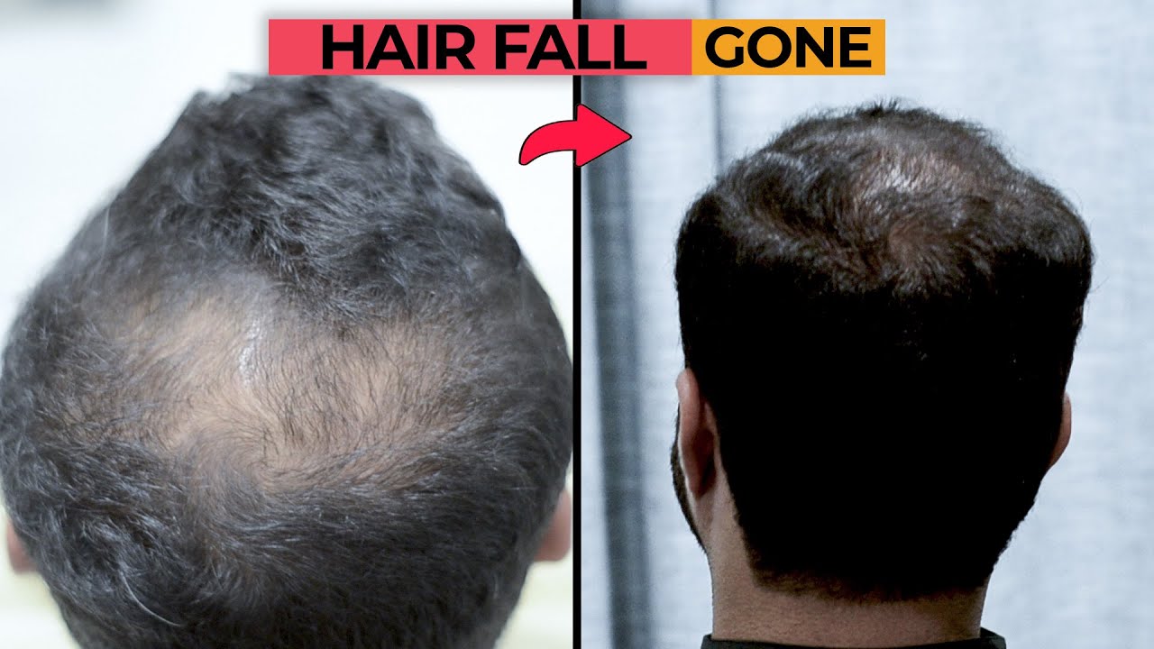 Severe Hair Fall to Hair Regrowth - Advance Hair PRP - YouTube