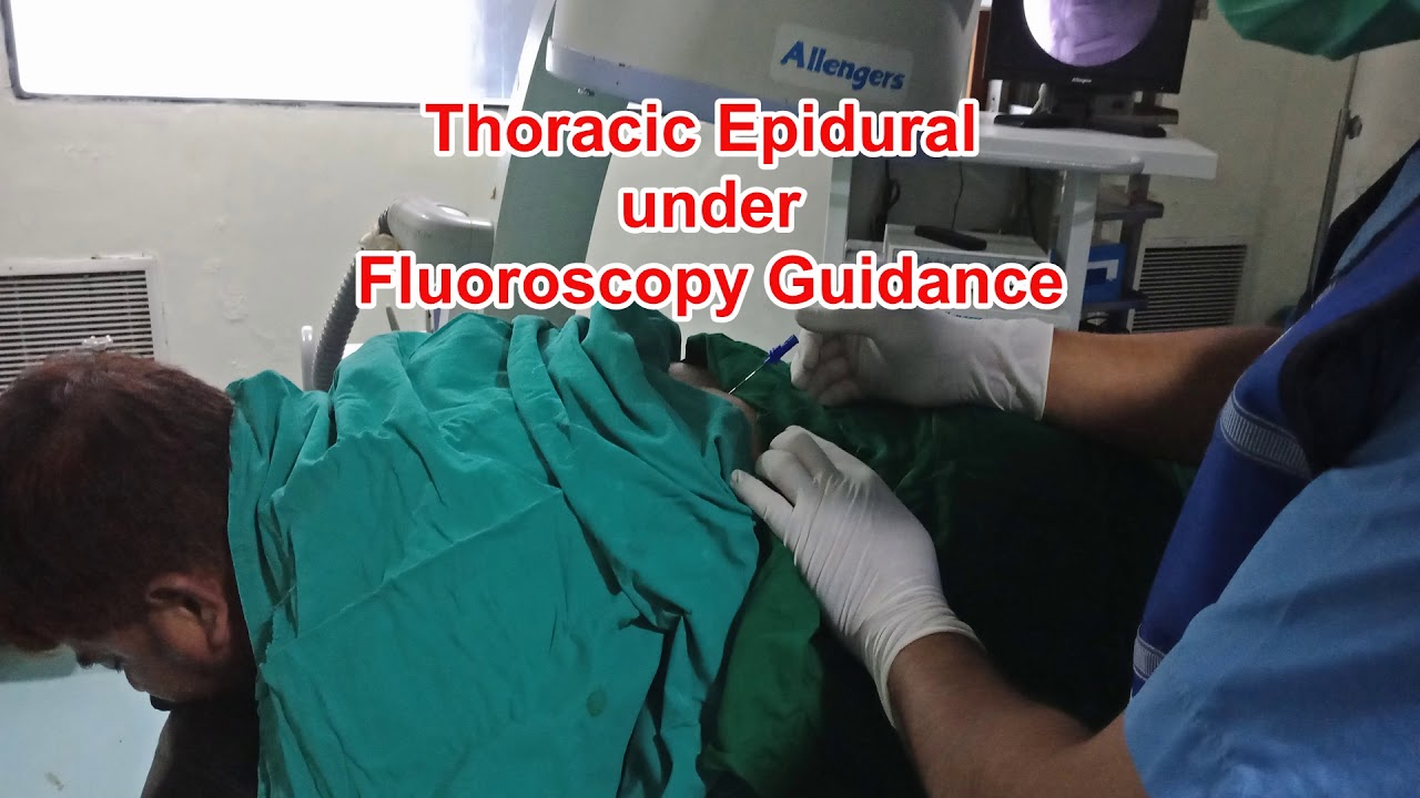 Thoracic epidural under Fluroscopy guidance by Dr Shantanu Mallick ...