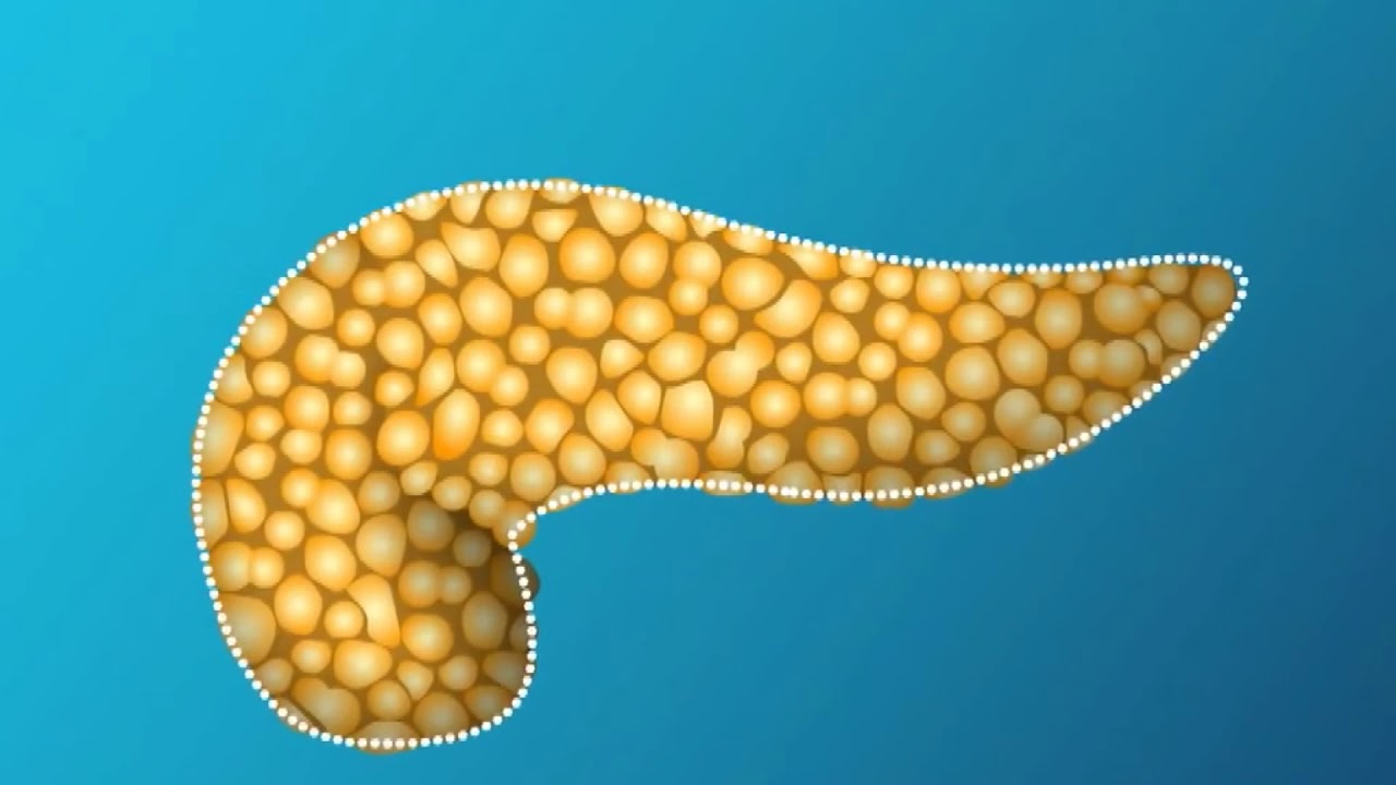 Pancreatitis enfermedad delicada - YouTube
