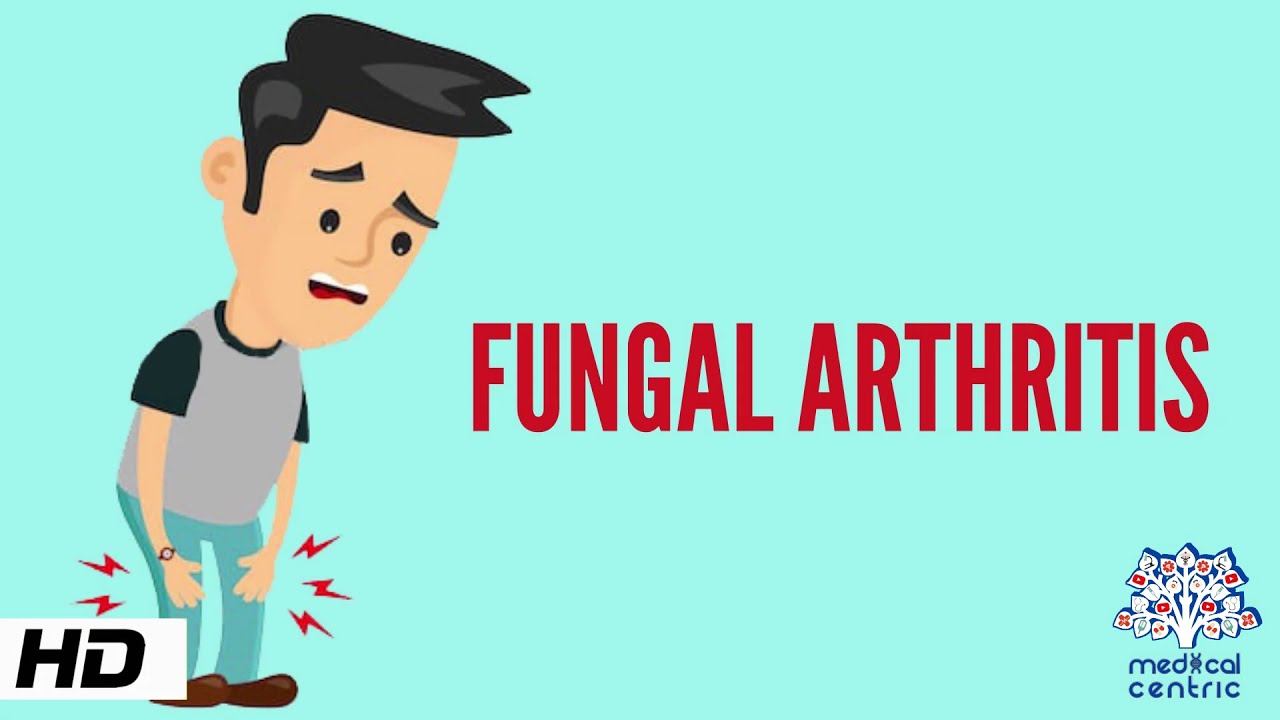 Fungal Arthritis, Causes, Signs and Symptoms, Diagnosis and Treatment ...