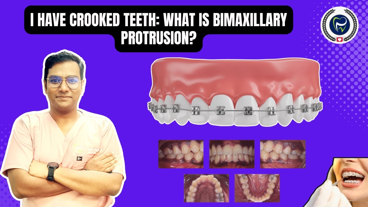 Dr Rudra Mohan | I Have Crooked Teeth: What is Bimaxillary Protrusion ...