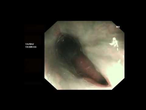 CERVICAL INLET PATCH - YouTube