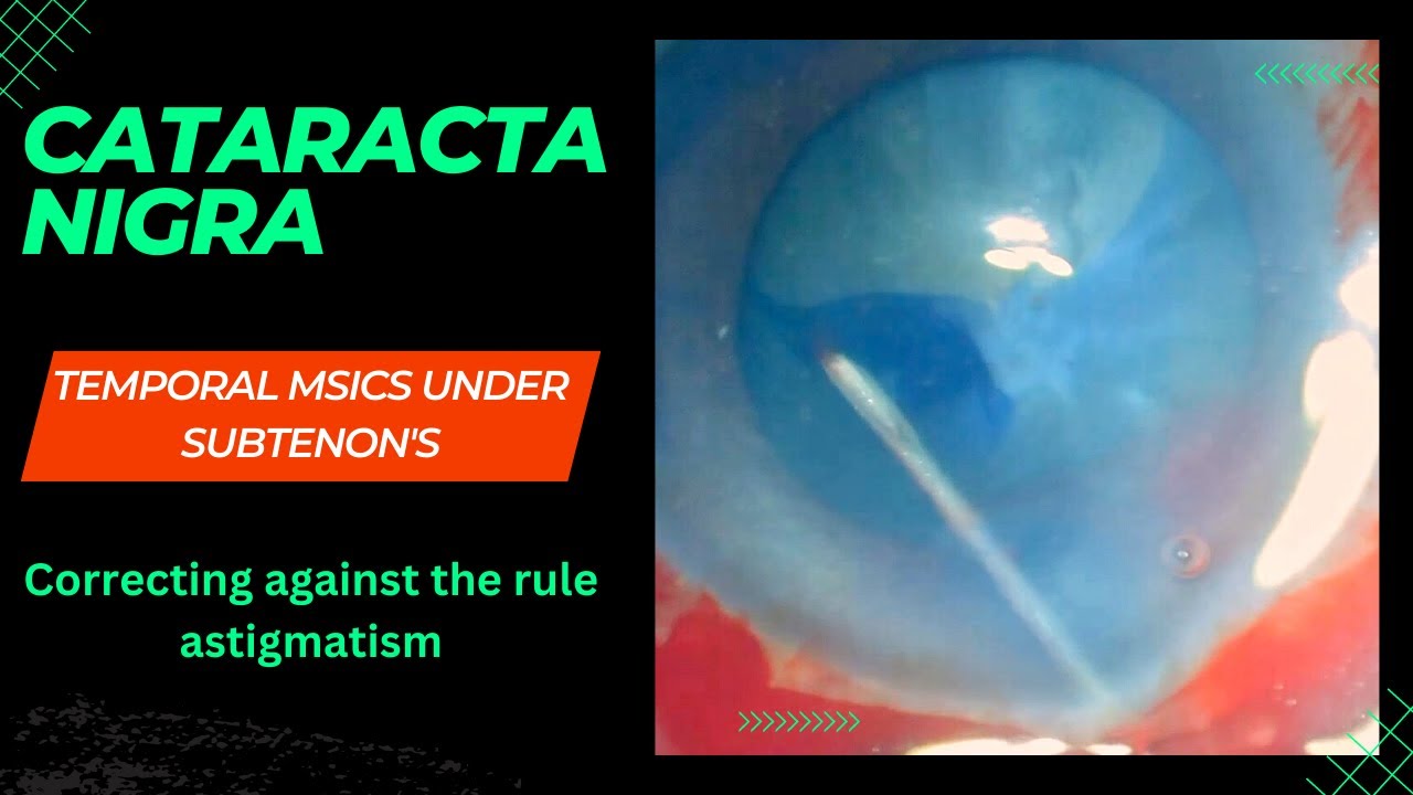 Case series 58. Cataracta nigra black cataract temporal SICS under ...