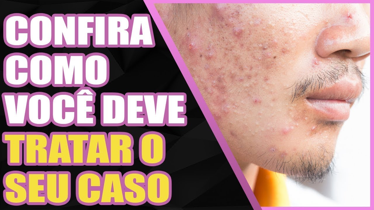 Conheça os 4 Graus da Acne e Saiba Como Cada Um Deve Ser Tratado - YouTube