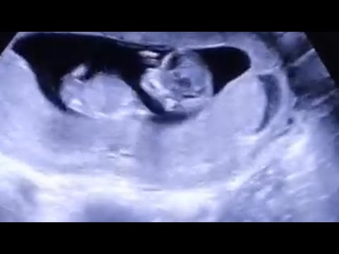 Retro placental hematoma, placenta detachment! - YouTube
