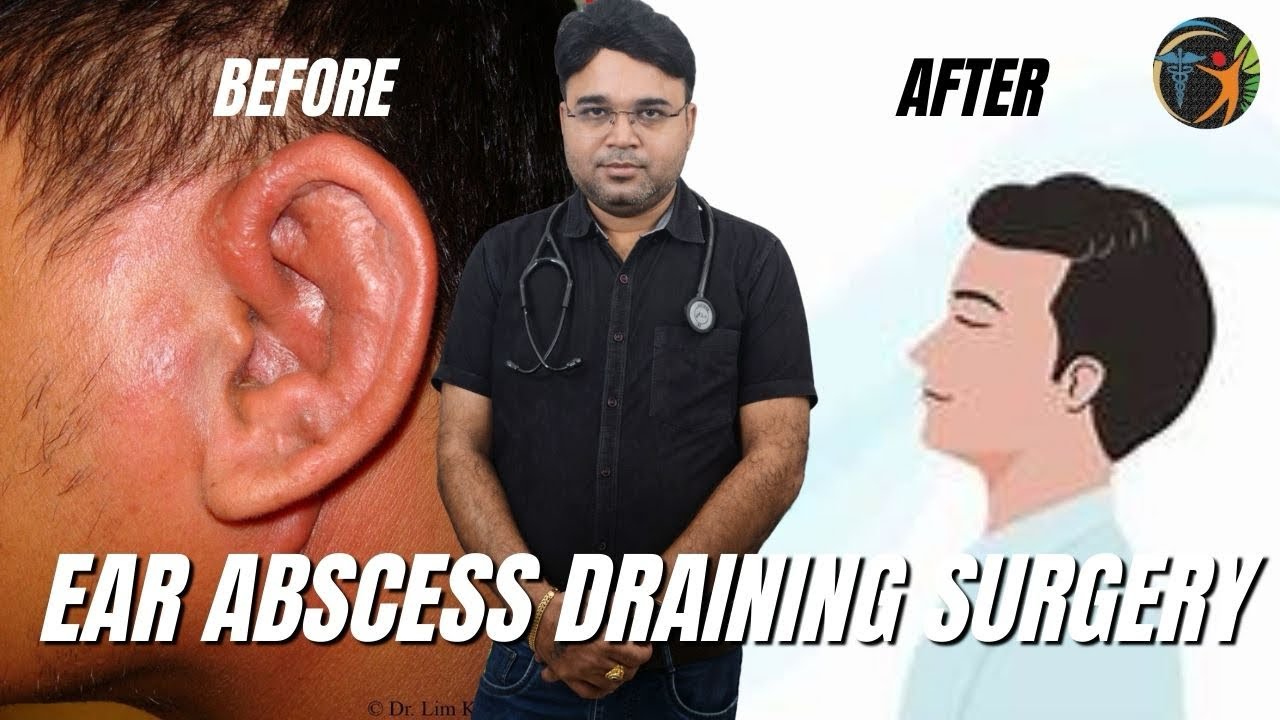 Ear Abscess Draining Surgery | Before & After Results | Badlapur ...