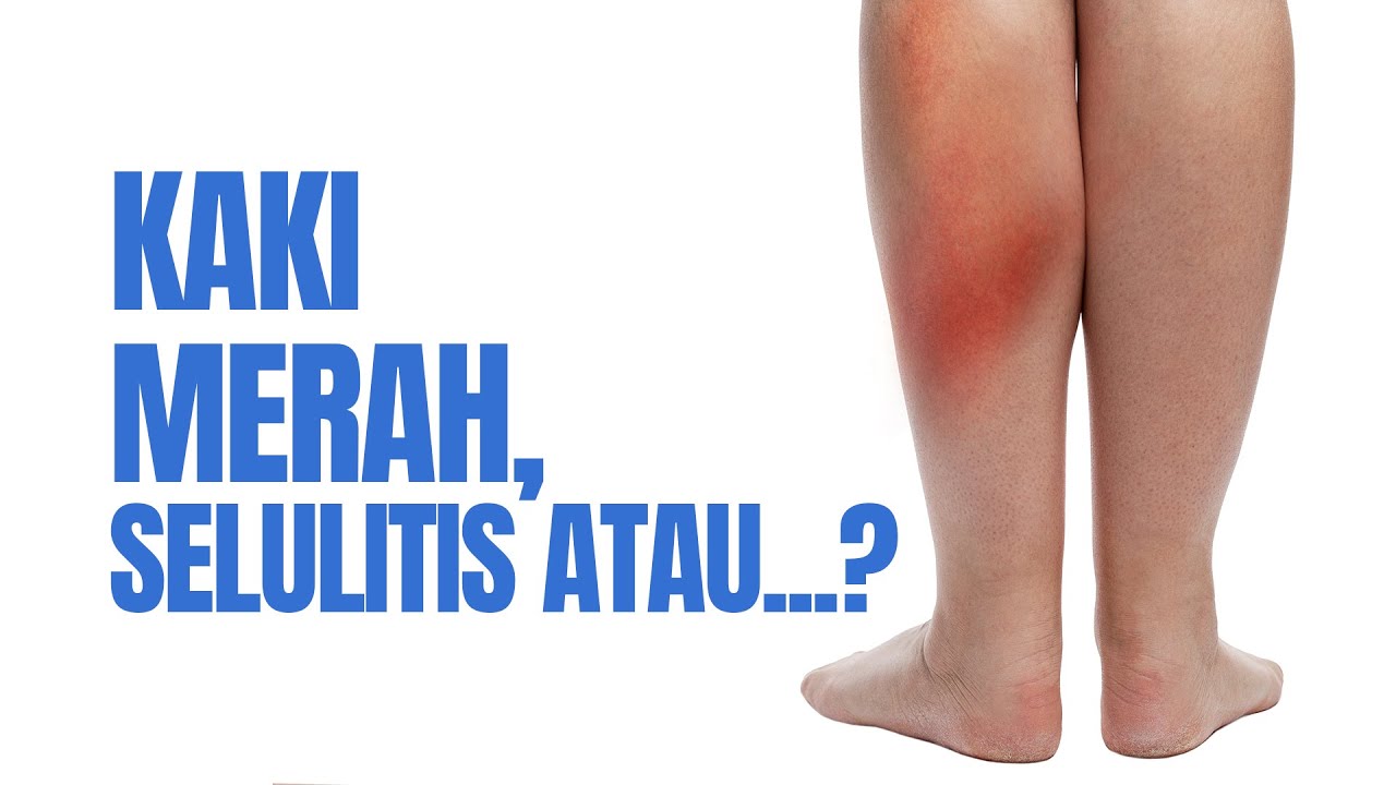 Cara Membedakan Tanda-tanda Selulitis dengan Lainnya - YouTube
