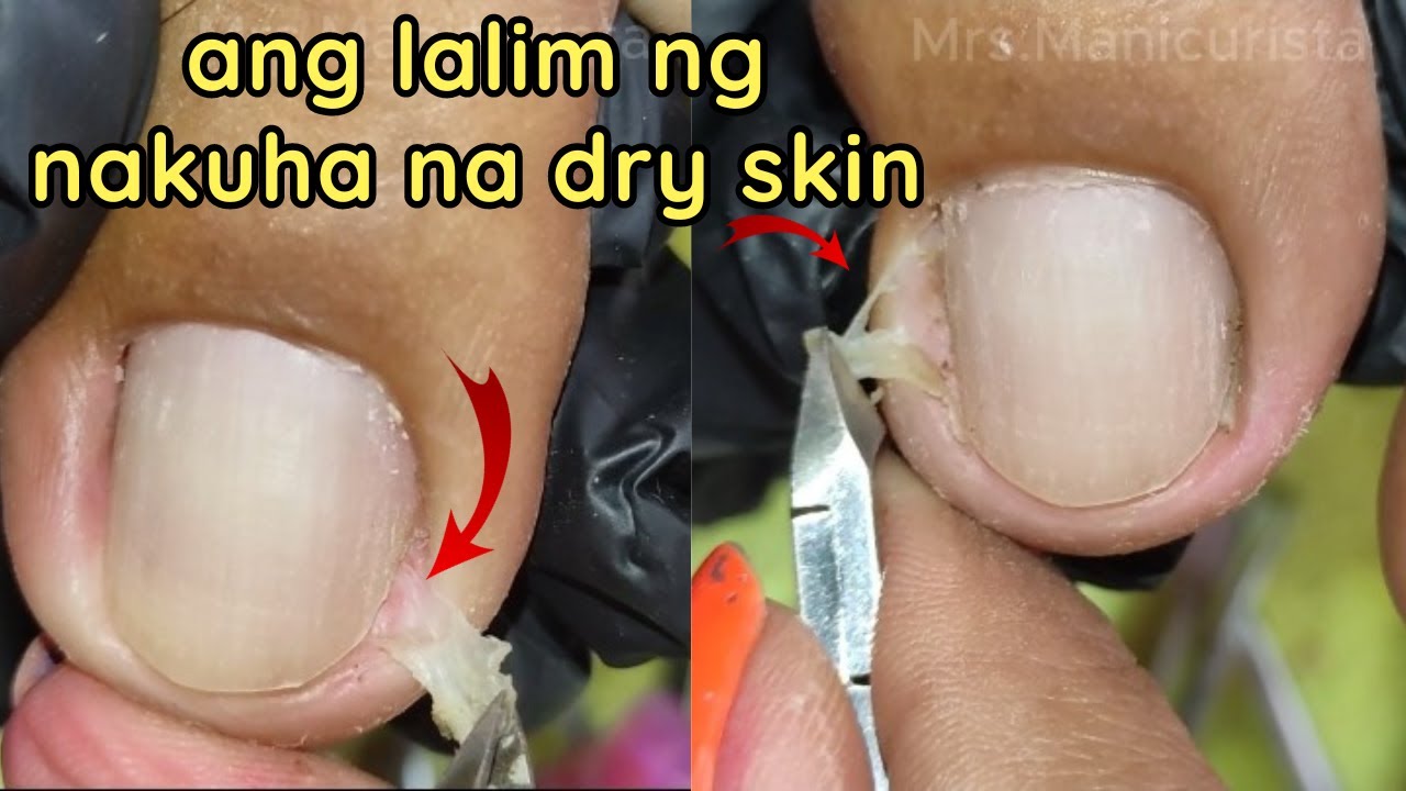 Vlog 1043|Dry Skin/Ingrown Removal| PEDICURE 943 - YouTube