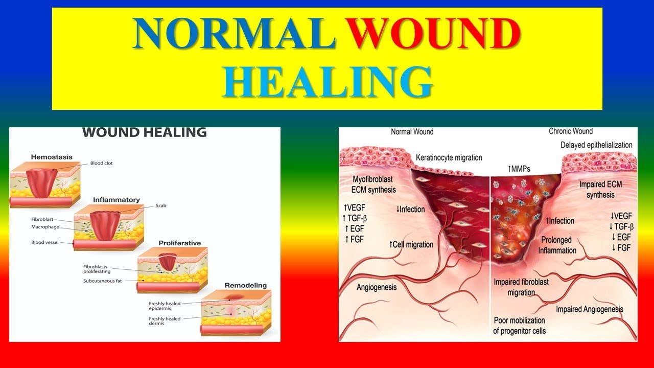 NORMAL WOUND HEALING - YouTube