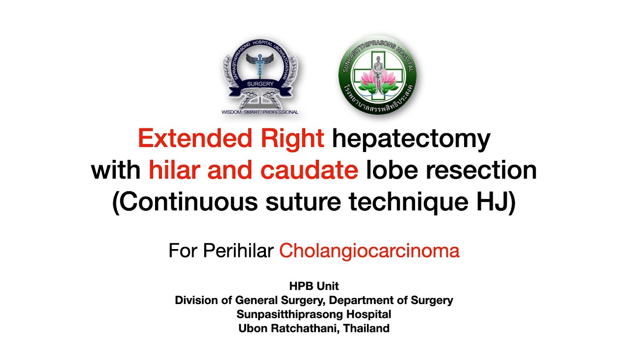 Extended Right Hepatectomy with Hilar and Caudate lobe resection for ...