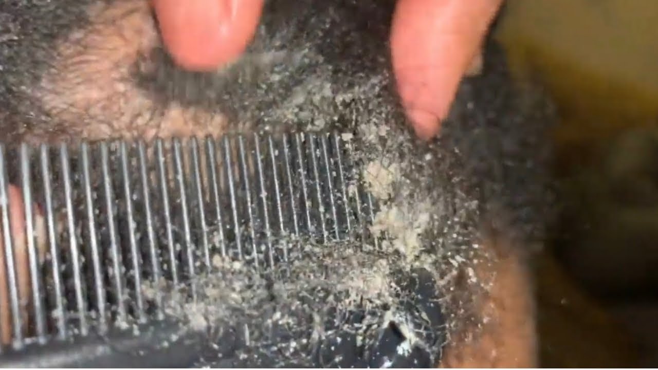 Extreme Dandruff Scratching Asmr Major Flakes Part 1 Youtube