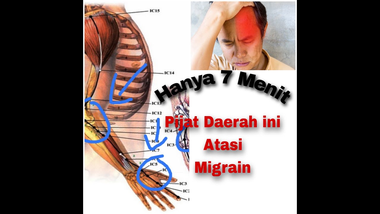 Sering sakit Kepala dan Migrain jangan cemas, kombinasi beberapa titik ...