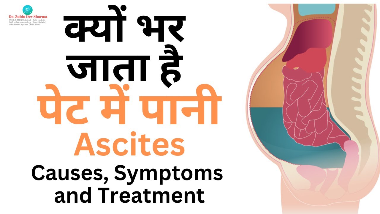 Ascites Causes Pictures Symptoms And Treatment