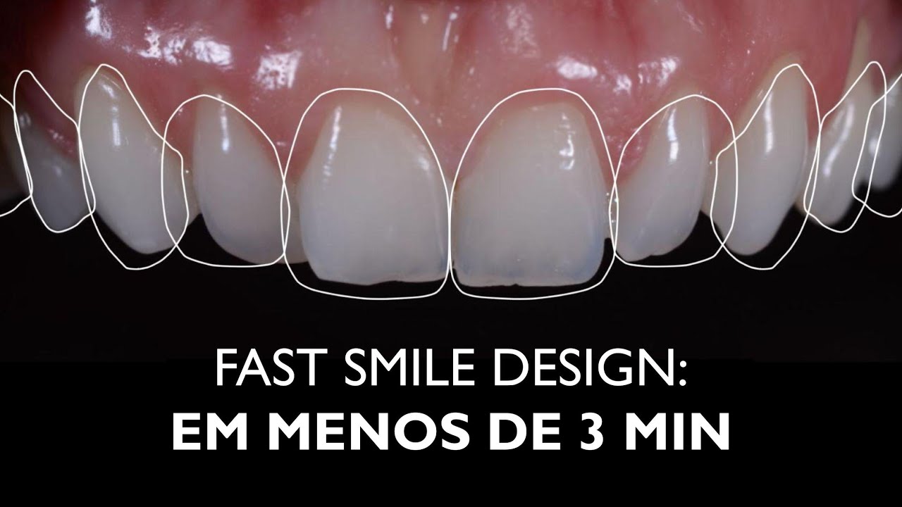 Fast Smile Design - Mini Tutorial - YouTube