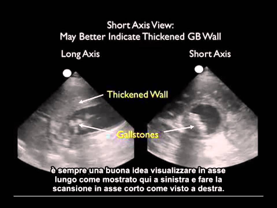 Video procedurale: Ecografia della cistifellea, parte 3 - Colecistite ...