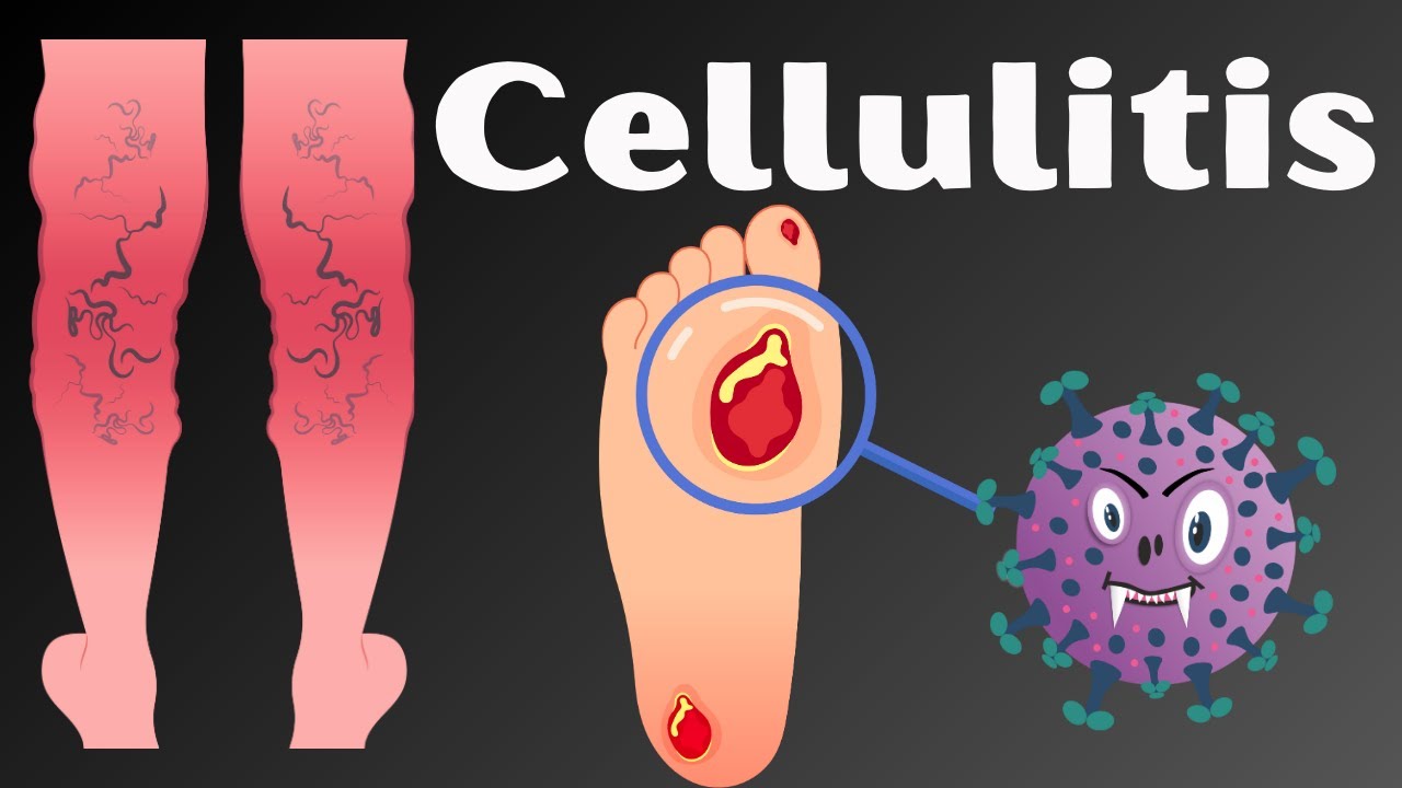 Cellulitis: Causes, Signs & Symptoms, Pathophysiology, Diagnosis, and ...