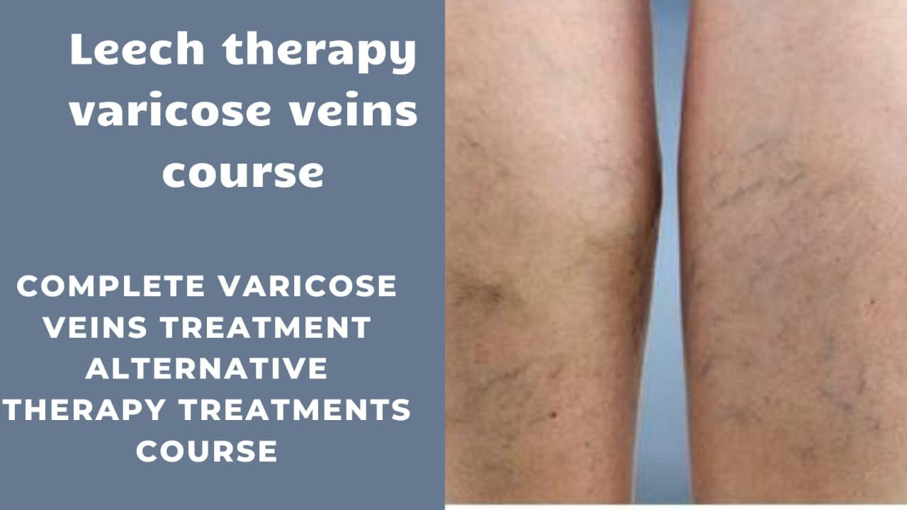 What is Leech Therapy 1 | Vericose veins therapy course #leechtherapy ...