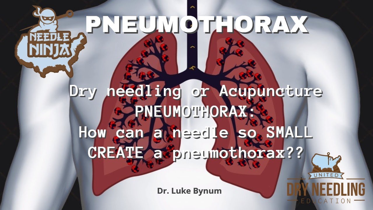 What Is Dry Needling Collapsed Lung