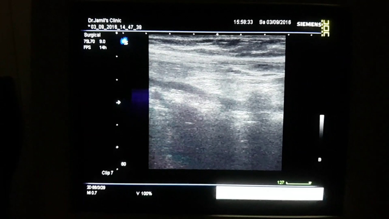 Bowel Diverticulum Sonography Youtube