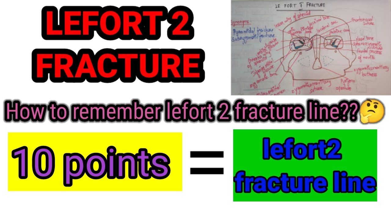 Lefort 2 fracture line|Just in 10 points|Exam ready notes|Lefort 2 ...