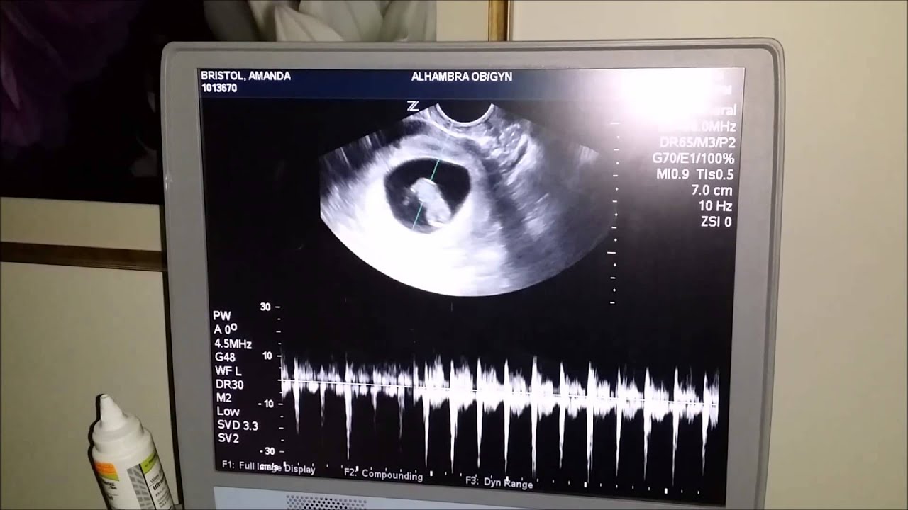 8 week 5 day ultrasound - YouTube