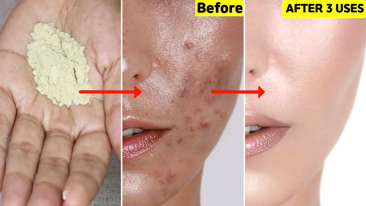 Facewash🙅🏻नहीं मैंने इसे आज़माया-Acne, Bumps, Oily skin, Pigmentation ...