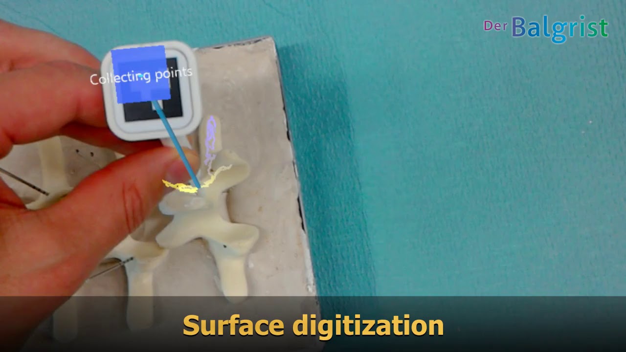 Pedicle screw navigation using surface digitization on the Microsoft ...