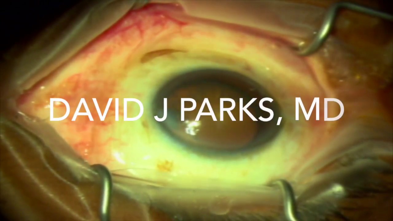Macular Hole Surgery with 27 gauge Pars Plana Vitrectomy - YouTube