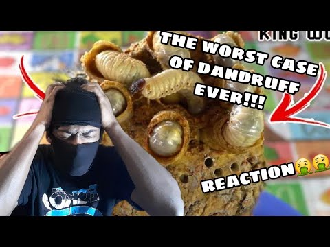 THE WORLD'S WORST CASE OF DANDRUFF!!! - YouTube