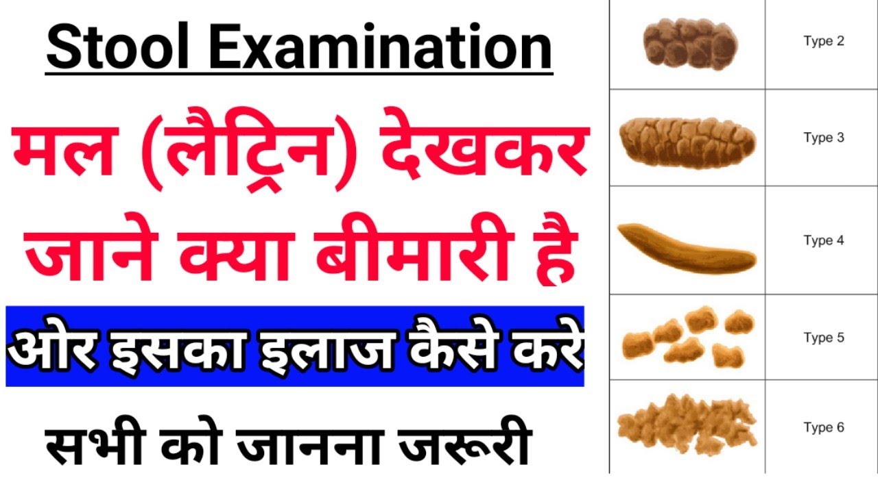 मल (लेट्रिन) को देखकर बीमारी के बारे मे जाने - Stool examination || सभी ...
