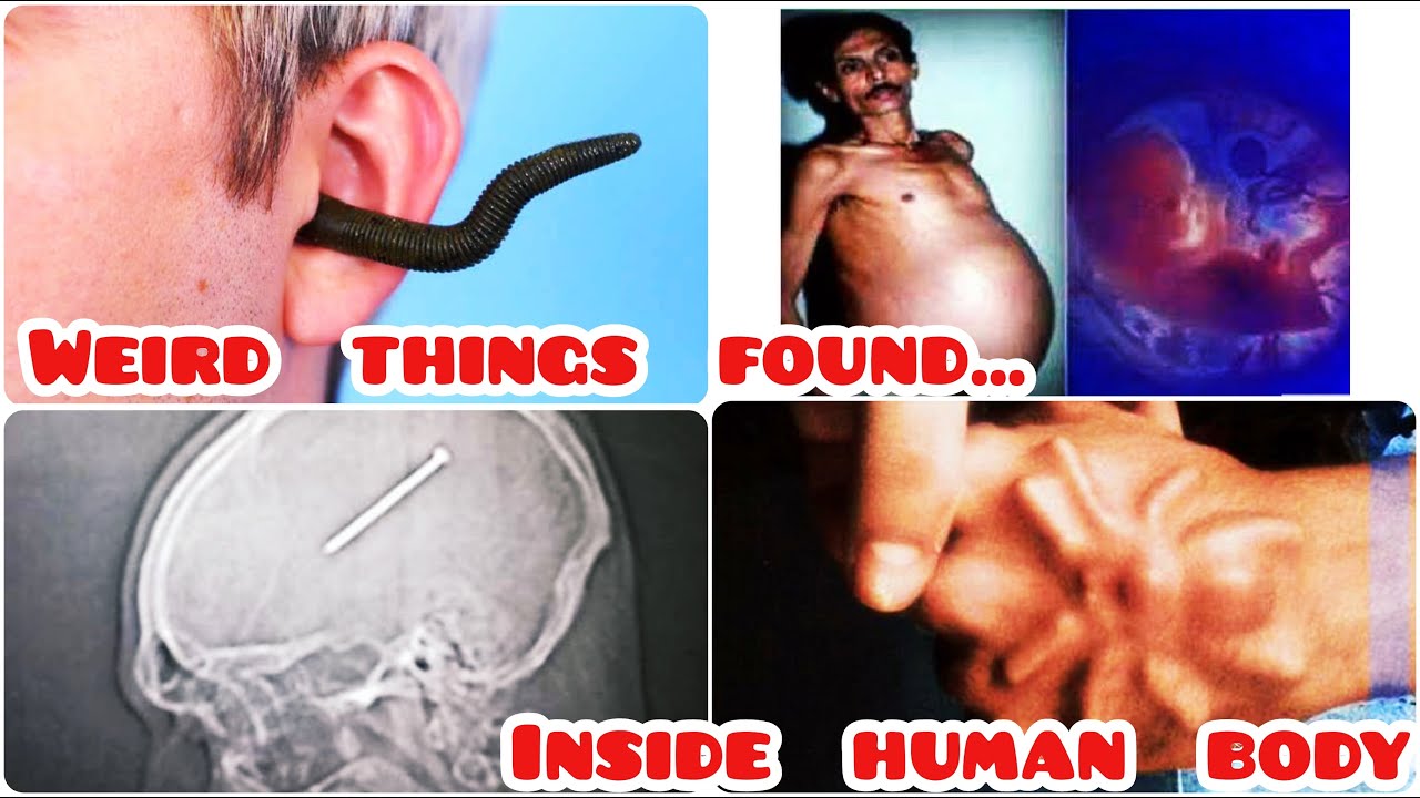 Weird things doctors removed from human body - இது எப்படி உடம்புக்குள்ள ...