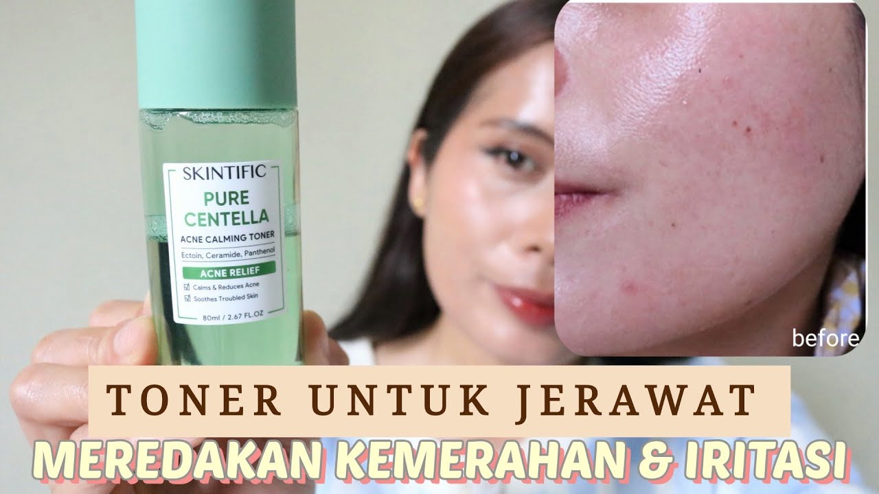 REVIEW SKINTIFIC PURE CENTELLA ACNE CALMING TONER UNTUK JERAWAT ...