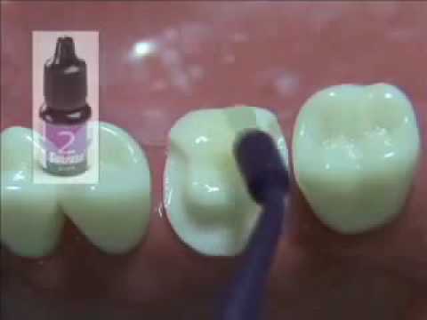 CEREC Onlay Delivery Utilizing Interface, Surpass, and Anchor - YouTube