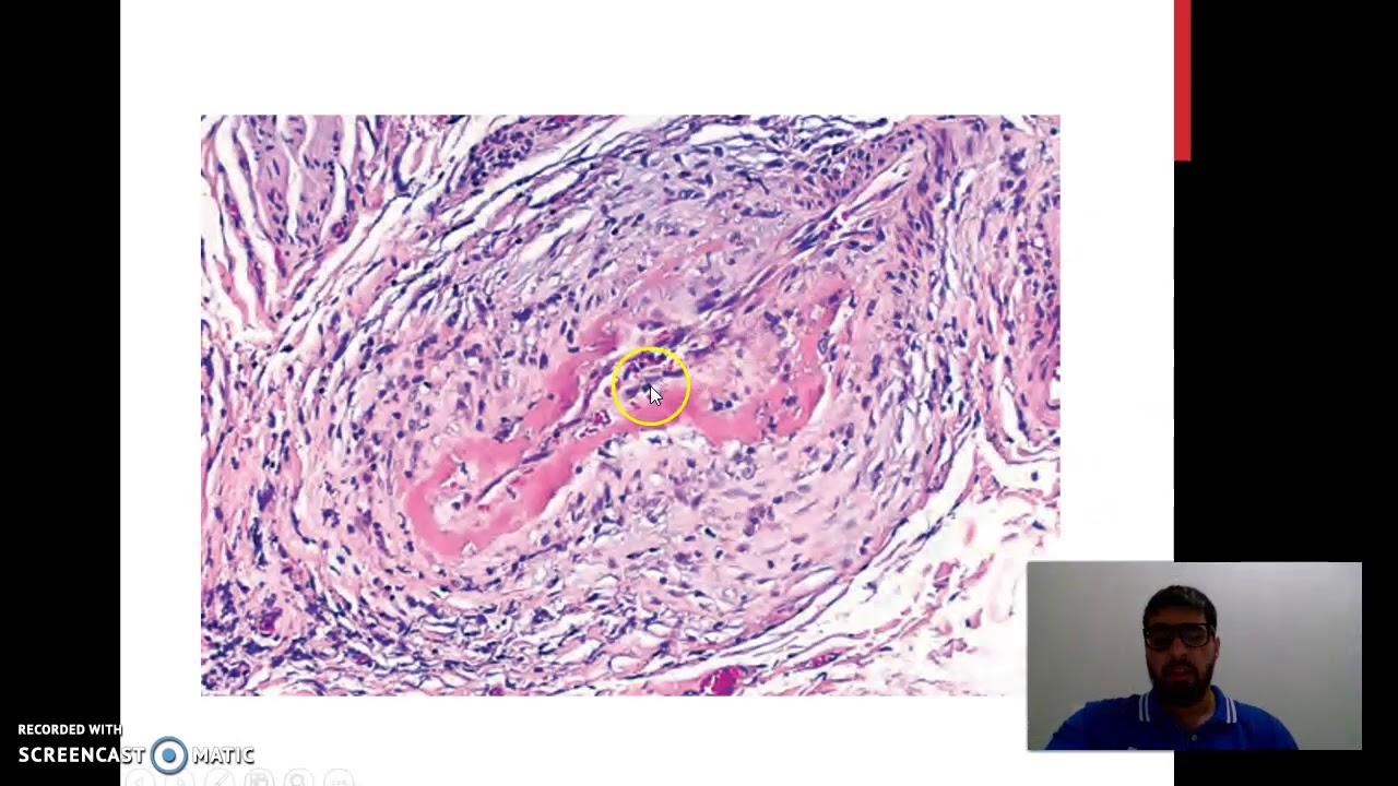 Vasculitis 11 Youtube