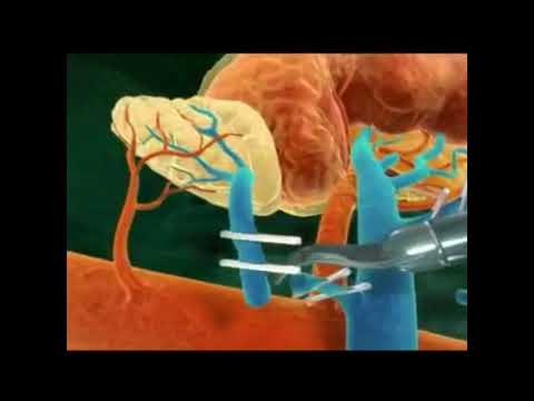 ANIMACIÓN NEFRECTOMIA LAPAROSCOPICA - YouTube