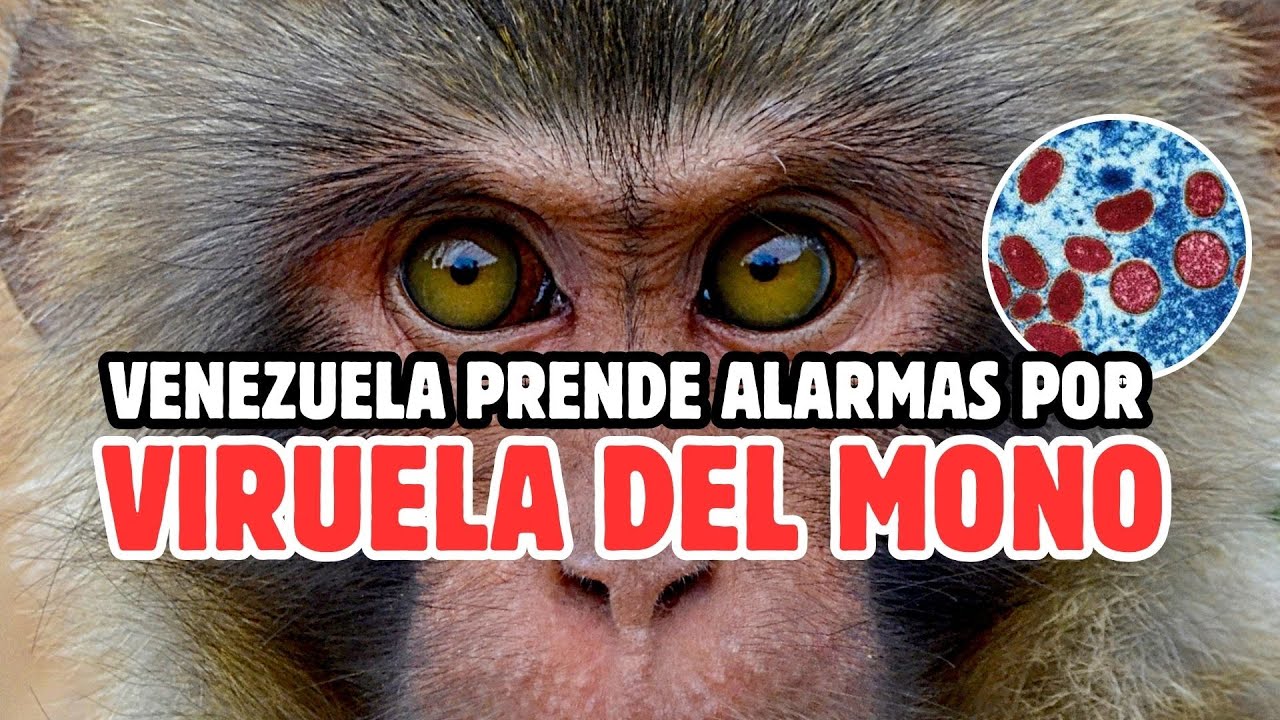 Venezuela se pone en alerta por la viruela del mono | Lo Que Está ...
