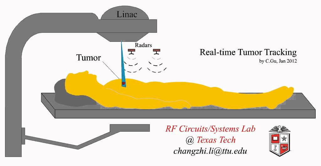 Linac Respirationmonitor Radiotherapy Lungcancermov Youtube