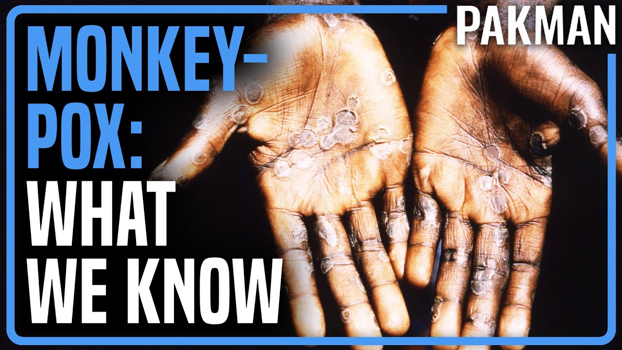 OH NO: Monkeypox Outbreak, Possibly Through Sex - YouTube